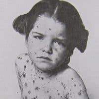 Top 10 Epidemic Diseases That Were Common in Ancient World